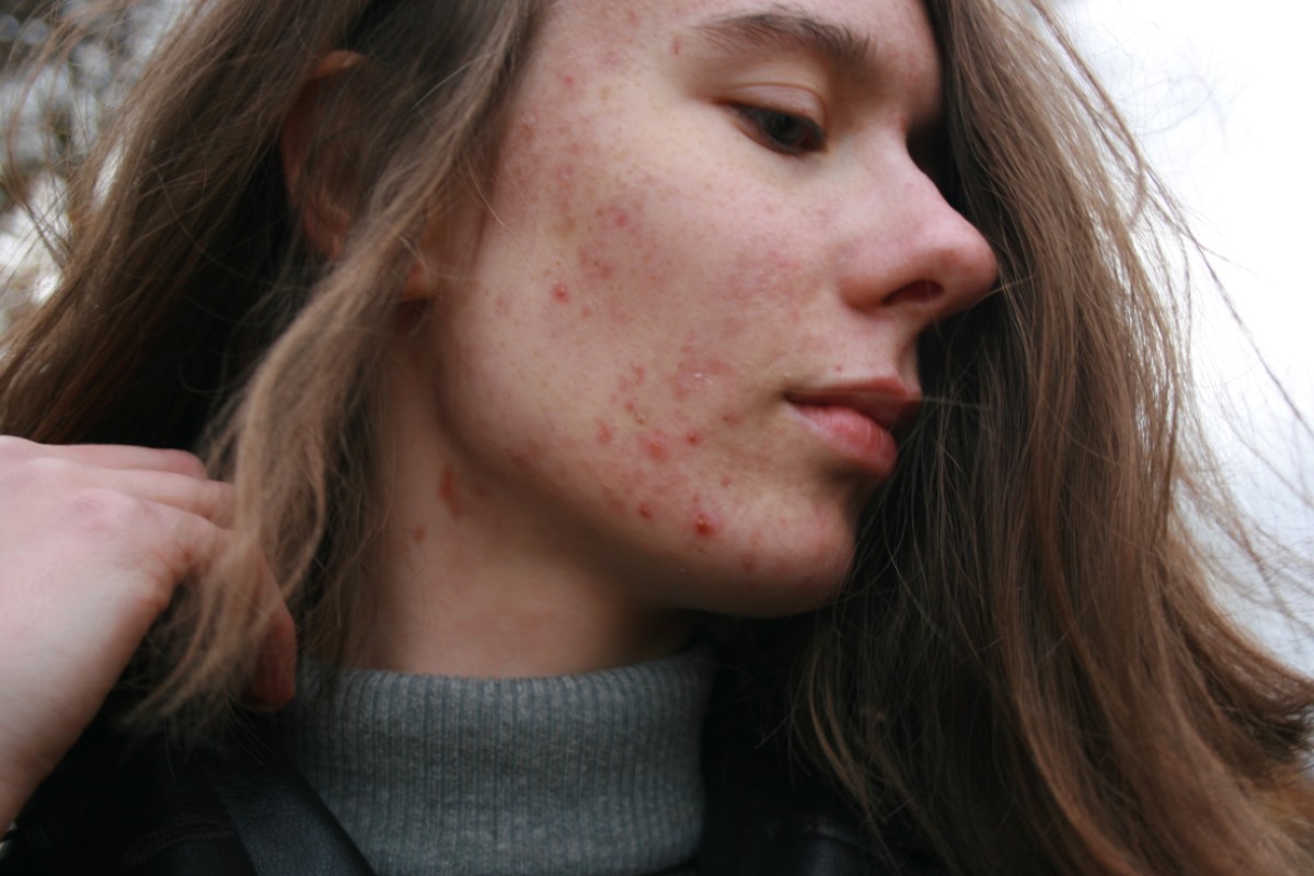 What Is Skin Purging And How To Treat It? - Women's Concepts