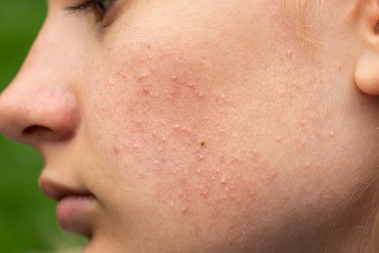 Dry Skin With Clogged Pores? Here's What To Do - Women's Concepts